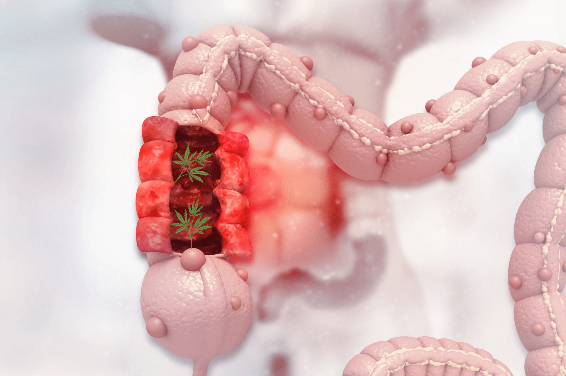 The best cannabinoids for colon cancer